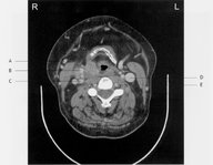 Overview of oral cavity , tonsil, tongue , salivary glands , and lip ...