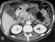 Acute pancreatitis - Knowledge @ AMBOSS