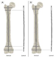 Femoral shaft fracture - Knowledge @ AMBOSS