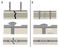 Dynamic hip screw fixation [1]