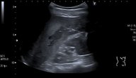 Pyogenic liver abscess - Knowledge @ AMBOSS