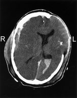 Elevated intracranial pressure and brain herniation - Knowledge @ AMBOSS