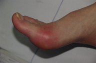 Gout and hyperuricemia - Knowledge @ AMBOSS