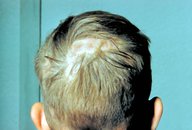 Dermatophyte infections - Knowledge @ AMBOSS