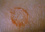 Dermatophyte infections - Knowledge @ AMBOSS