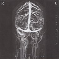 Cerebral venous thrombosis - Knowledge @ AMBOSS