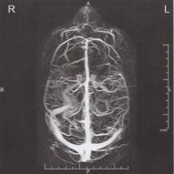 Cerebral venous thrombosis - Knowledge @ AMBOSS