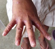 Rash - Knowledge @ AMBOSS