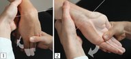 Carpal tunnel syndrome - Knowledge @ AMBOSS