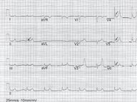 ECG - Knowledge @ AMBOSS