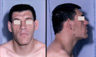 Acromegaly - Knowledge @ AMBOSS