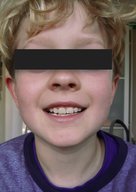 Mastoiditis - Knowledge @ AMBOSS