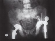 Bone metastases - Knowledge @ AMBOSS
