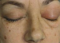 Orbital disorders - Knowledge @ AMBOSS