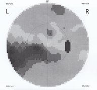 Disorders of the visual pathway - Knowledge @ AMBOSS