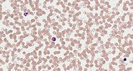 Erythrocyte morphology and hemoglobin - Knowledge @ AMBOSS