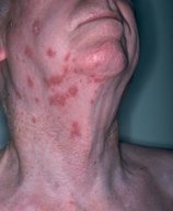 Shingles - Knowledge @ AMBOSS