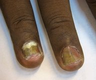 Dermatophyte infections - Knowledge @ AMBOSS