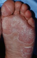 Dermatophyte infections - Knowledge @ AMBOSS