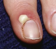 Finger and toe infections - Knowledge @ AMBOSS