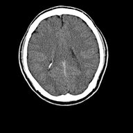 Subarachnoid hemorrhage - Knowledge @ AMBOSS
