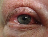 Eye pain and red eye - Knowledge @ AMBOSS