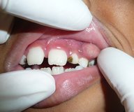 Dental disorders - Knowledge @ AMBOSS