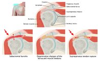 Soft tissue lesions of the shoulder - Knowledge @ AMBOSS
