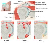 Soft tissue lesions of the shoulder - Knowledge @ AMBOSS