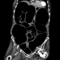 Megacolon - Knowledge @ AMBOSS