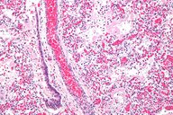 Acute respiratory distress syndrome - Knowledge @ AMBOSS