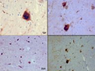 Parkinson-plus syndromes - Knowledge @ AMBOSS