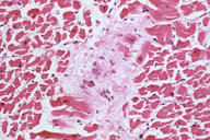 Acute rheumatic fever - Knowledge @ AMBOSS