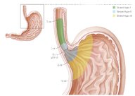 Esophageal cancer - Knowledge @ AMBOSS