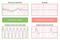 Cardiac arrest and cardiopulmonary resuscitation - Knowledge @ AMBOSS