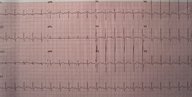 Option 2: Stable tachycardia - Knowledge @ AMBOSS