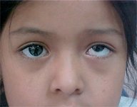 Ocular motility disorders and strabismus - Knowledge @ AMBOSS