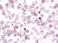 Erythrocyte morphology and hemoglobin - Knowledge @ AMBOSS