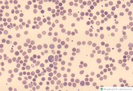Hemolytic anemia - Knowledge @ AMBOSS