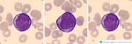 Acute leukemia - Knowledge @ AMBOSS