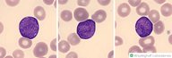 Acute leukemia - Knowledge @ AMBOSS