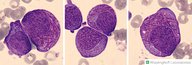 Acute leukemia - Knowledge @ AMBOSS