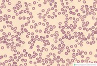 Erythrocyte morphology and hemoglobin - Knowledge @ AMBOSS