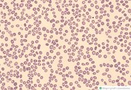 Hemolytic anemia - Knowledge @ AMBOSS