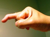 Boutonniere deformity [1] [2]