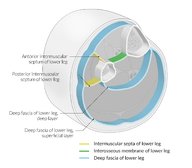 Acute compartment syndrome - Knowledge @ AMBOSS