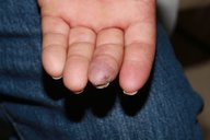 Systemic sclerosis - Knowledge @ AMBOSS