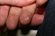 Systemic sclerosis - Knowledge @ AMBOSS