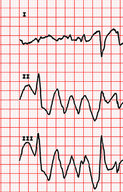 Ventricular tachycardia - Knowledge @ AMBOSS