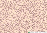 Erythrocyte morphology and hemoglobin - Knowledge @ AMBOSS